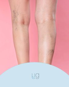 Salud vascular femenina: cómo afectan las varices a las mujeres en cada ...