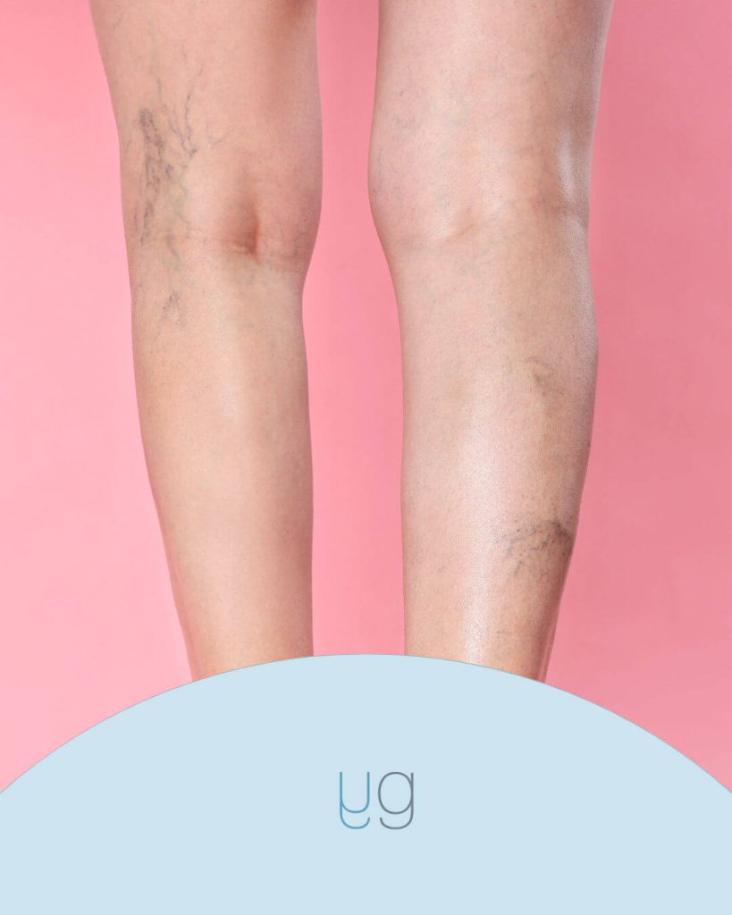 Salud vascular femenina: cómo afectan las varices a las mujeres en cada ...